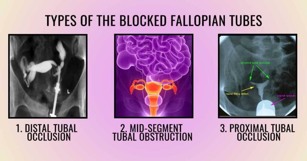NATURAL REMEDY FOR BLOCKED FALLOPIAN TUBES