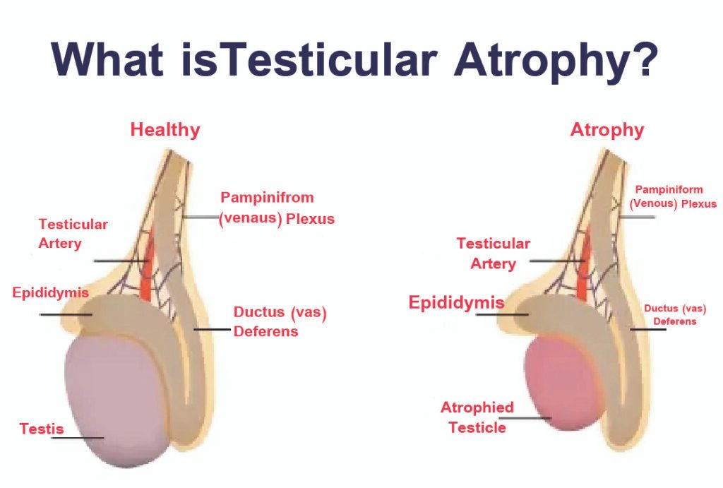 Testicular Atrophy: Causes, Symptoms & a Natural Fertility Remedy